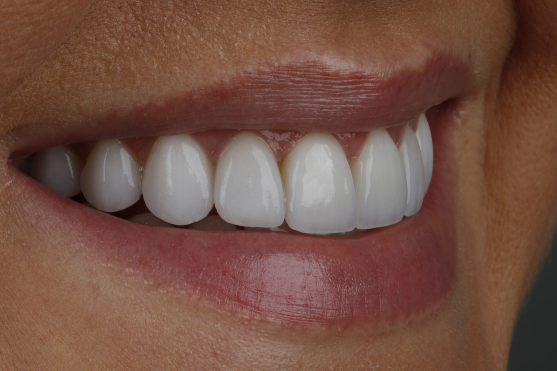 eSmile Premium | eSmile Hammasklinikka